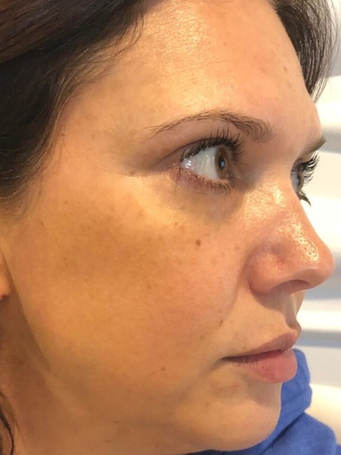 Patient 21555 - Quintessa Aesthetic Center