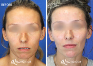 Juvéderm® | Quintessa Aesthetic Center